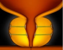 UroLift | BPH Treatment with the UroLift System